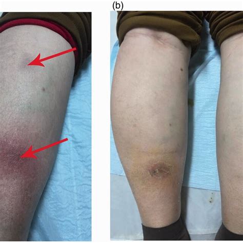 Photographs Of Erythema Nodosum Migrans Enm A A Unilateral Plaque Download Scientific