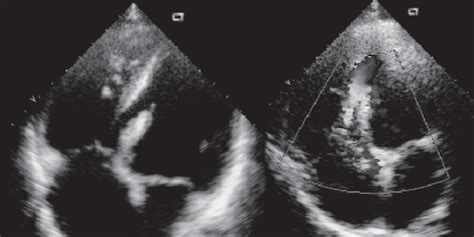 Apical 4 Chamber View Showing Oblique Muscular Vsd And Dilated Ra And Download Scientific