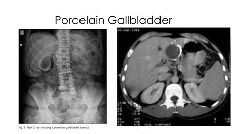Ppt Gallbladder Disease Powerpoint Presentation Free Download Id