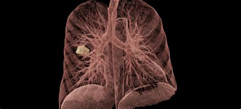 Non Smoker Lungs Vs Smoker