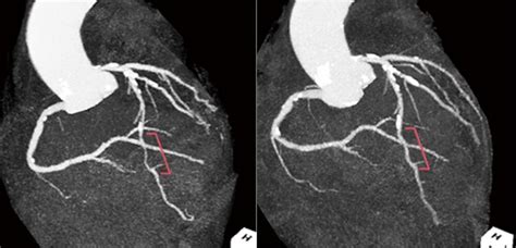A Dietary Supplement Leads To Remarkable Regression In Atherosclerotic