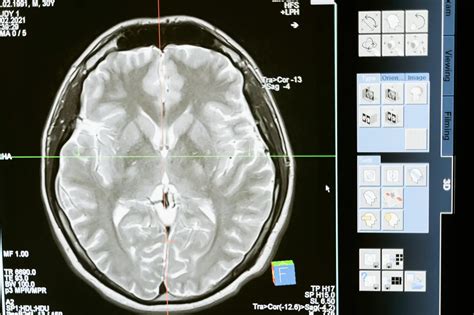 Why Recommend Lithium For Cognitive Health Why Recommend Lithium For Cognitive Health
