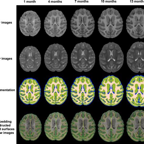 The Segmentation Results Of A Typical Subject With Five Longitudinal