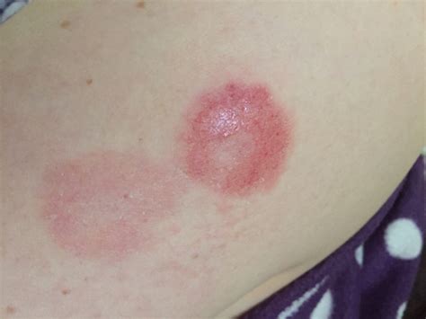 Freestyle Libre Sensor Allergic Reaction Sensor Web Blog