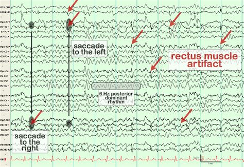 Lateral Eye Movement