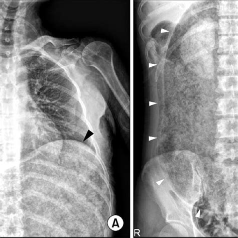 Abdominal Ct Shows Compression Of The Third Portion Of Duodenum Between Download Scientific