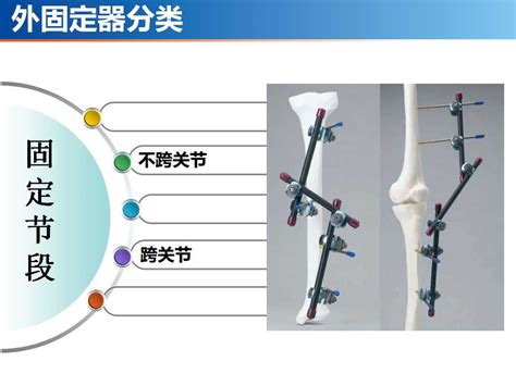 骨科常见的外固定架及其临床应用 好医术早读文章 好医术 赋能医生守护生命