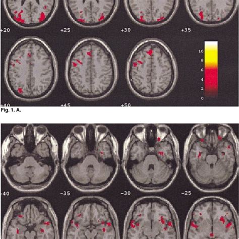 Comparison Of The Brain Activation Patterns Between A Healthy Volunteer