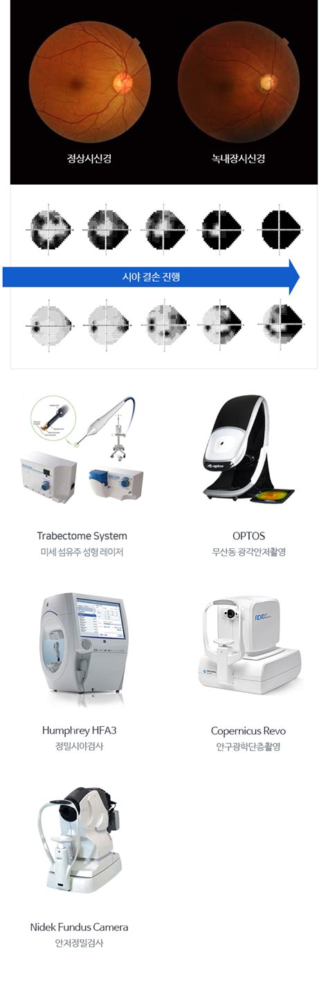 녹내장 검사 A21
