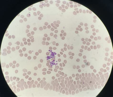检验临床面对面EDTA 依赖性聚集or 时间依赖性聚集 学术交流 检验视界 检验视界网