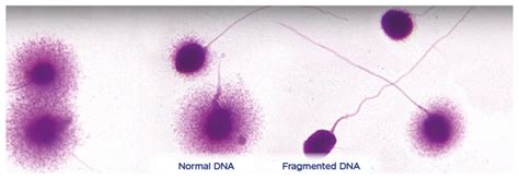 Lifestyle Factors Associated With Increased Sperm Dna Fragmentation And Their Impact On
