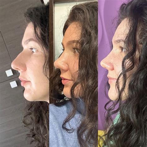 Rhinoplasty Swelling Progression Rplasticsurgery