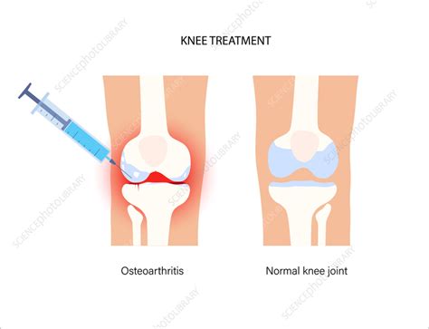Knee Injection Illustration Stock Image F0366332 Science Photo Knee Injection Illustration Stock Image F0366332 Science Photo