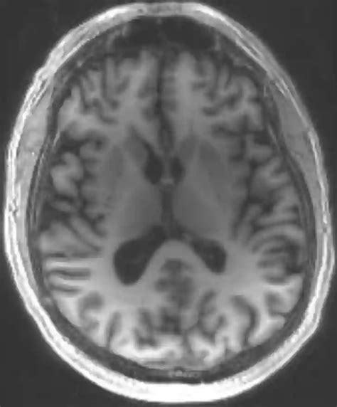 Mdeft Sequenz Mri Ars Neurochirurgica