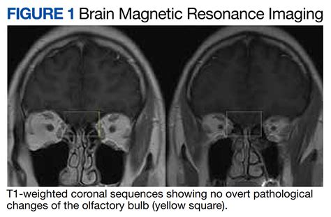 Olfactory Hallucinations