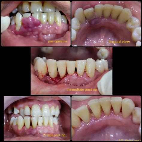 Surgical Excision Of Pyogenic Granuloma In A 43 Year Old Male Diabetic Patient Sahla Ambadi