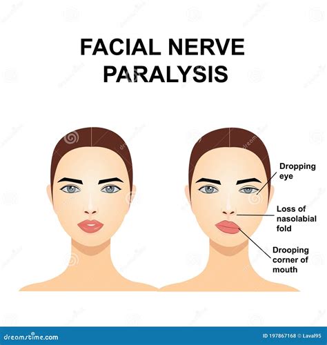 Paralysis Of The Facial Nerve Bell`s Palsy Stock Vector Illustration Of Human Therapy 197867168