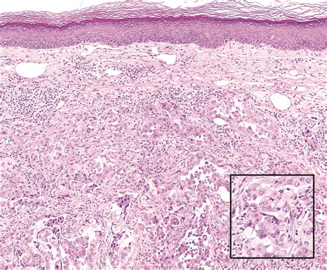 Rapidly Growing Scalp Nodule Mdedge