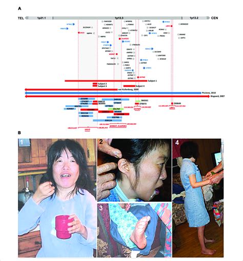 A Comparative Cnv Mapping Of Subjects With Cnvs At 1p133 Deletions
