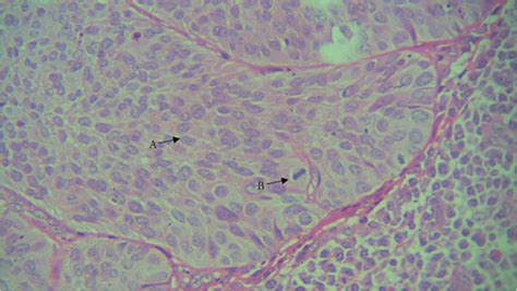 40× View A Basaloid Cells And B Mitotic Figure Download Scientific Diagram