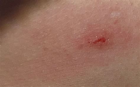 진드기에 물린자국인가요 지식in