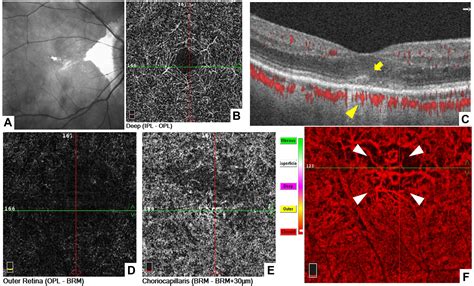 Video Color Oct Angiography For Myopic Choroidal Neovascularization Ophthalmology Retina