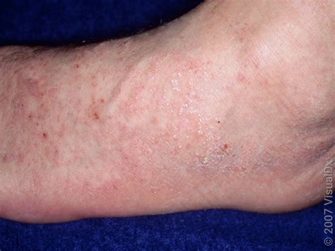 Scabies Rash