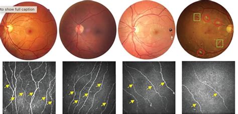 Diabetic Retinopathy Screening Philip Obermeyer Optometrists