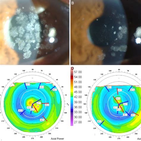 Ocular Biometric Parameters And Refraction In Patients With Granular Download Table