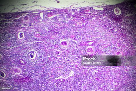 Foto De Amostra De Biópsia Do Glomérulonefrite Sob Microscopia E Mais