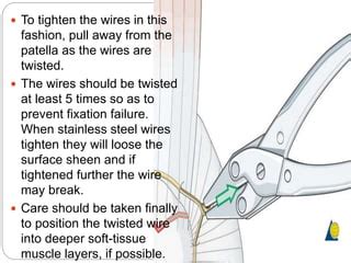 How To Do Tension Band Wire PPTX