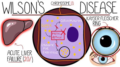 Wilsons Disease Histology Wilson Disease — The Impact Of