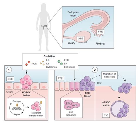 Molecular Management Of High Grade Serous Ovarian Carcinoma