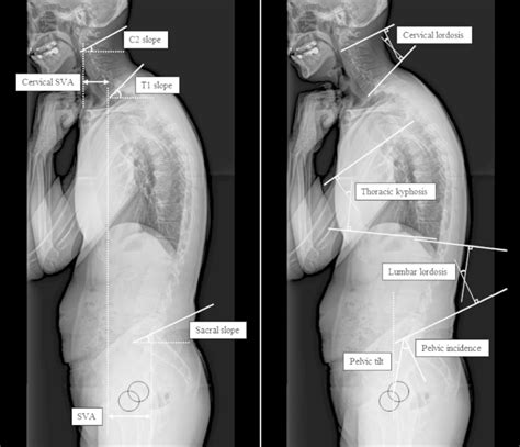 Radiographic Parameters Of Sagittal Alignment Sva Sagittal Vertical Download Scientific