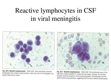 Fluid Cytology In Csf