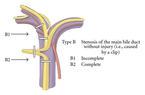 Clinical Application Of The Hanover Classification For Iatrogenic Bile