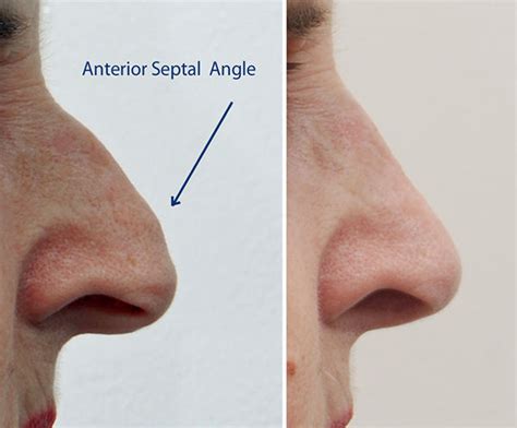 Aging Nose Rhinoplasty 01 By Tweety92 On Deviantart