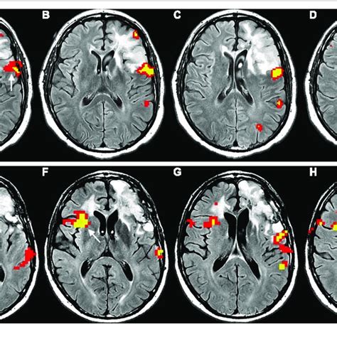 Longitudinal Representation Of Language Plasticity In A 43 Year Old Download Scientific