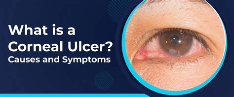 Corneal Ulcer Symptoms And Causes A Complete Overview