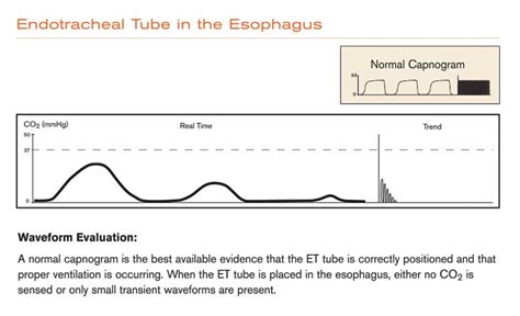 End Tidal Co2 Meaning End Tidal Oxygen Measurement White Paper