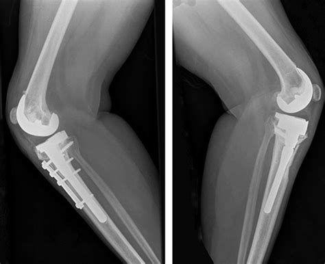 Tibial Tubercle Osteotomy Knee Brace At Joan Jordan Blog