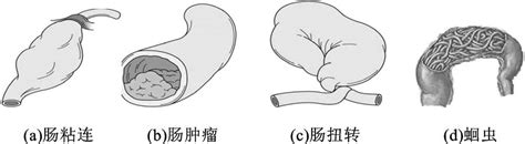 肠梗阻可以分为哪几类 再造人