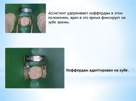 Коффердам оптидам, жидкий коффердам - презентация онлайн