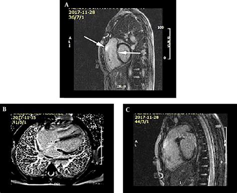 phase sensitive inversion recovery sequence post gadolinium in sagittal