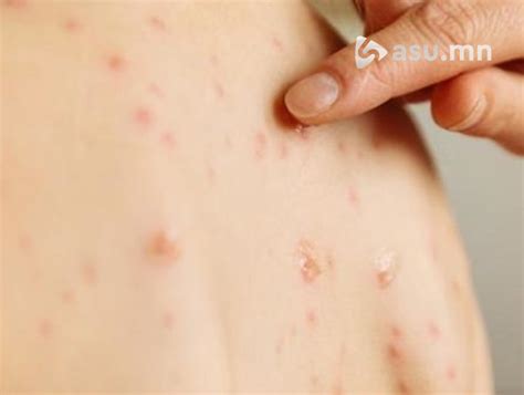 ХӨСҮТ Улаанбурхан өвчний батлагдсан тохиолдол 253 болжээ