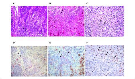 Detection Of Tumor Infiltrating B Lymphocytes In Malignant Melanoma