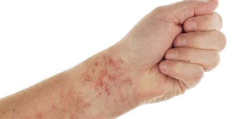 Skin Rash And STDs Symptoms Types Differentiation