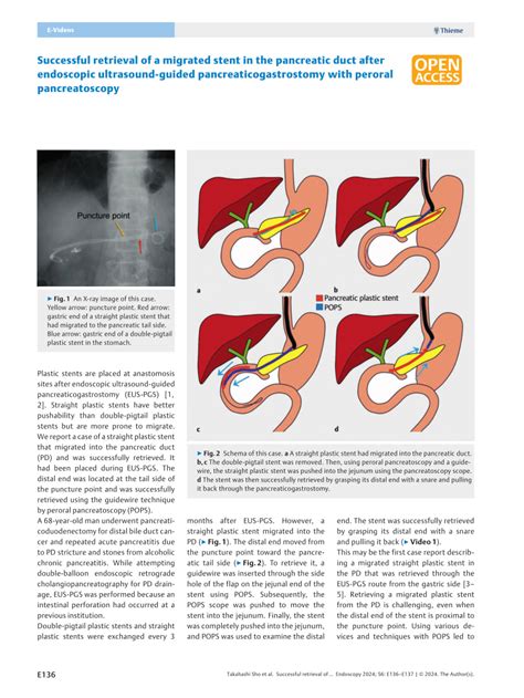 Pdf Successful Retrieval Of A Migrated Stent In The Pancreatic Duct After Endoscopic