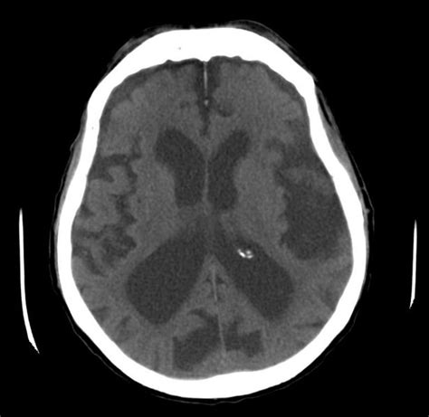 Cerebral Atrophy Wikidoc