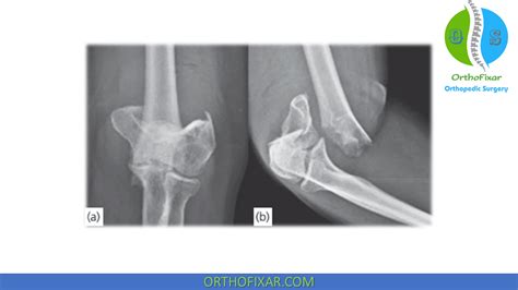 Distal Humerus Fracture Orthofixar